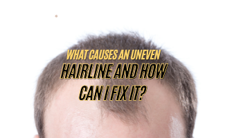 What Causes an Uneven Hairline and How can I Fix It? – Precise Scalp Micro