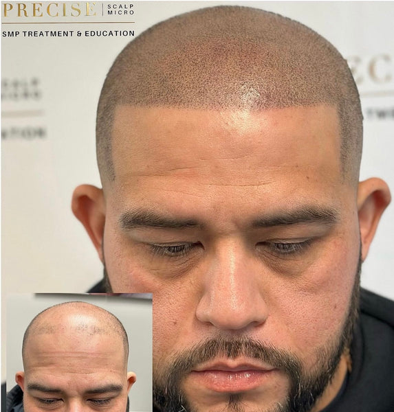 Todo lo que necesitas saber sobre la micropigmentación capilar para ho ...